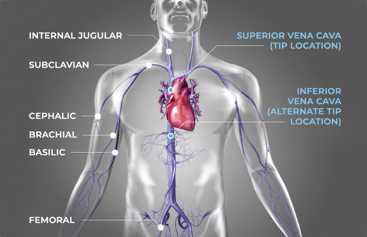 The Role of CVADs - Cathflo® Activase® (alteplase)