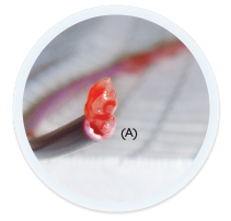 Types of Catheter Occlusions - Cathflo® Activase® (alteplase)