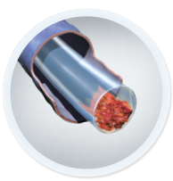Types of Catheter Occlusions - Cathflo® Activase® (alteplase)