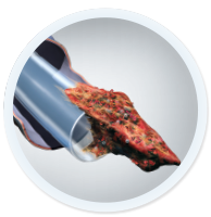 Types of Catheter Occlusions - Cathflo® Activase® (alteplase)