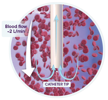 Treating Occluded Catheters - Cathflo® Activase® (alteplase)